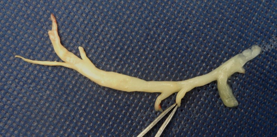 Kidney-Lung Cancer: Urinated out worm and blood clot. Then coughed out ...