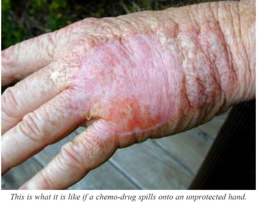 Extravasation: Leakage of Chemo-drug – CANCER STORY