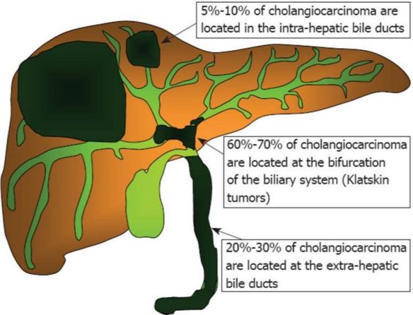 Bile Duct Cancer (cholangiocarcinoma) – CANCER STORY