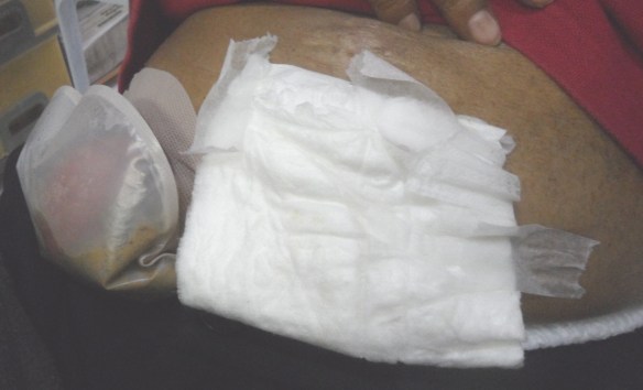 A Confused Medical Treatment of Colon Cancer – CANCER STORY